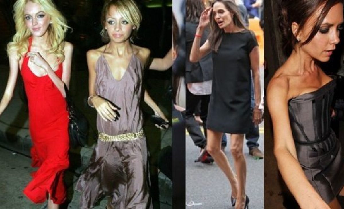 Impresionantes casos de anorexia en Hollywood | Vibra