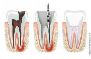 Cómo se "mata" el nervio de una muela: remedio casero